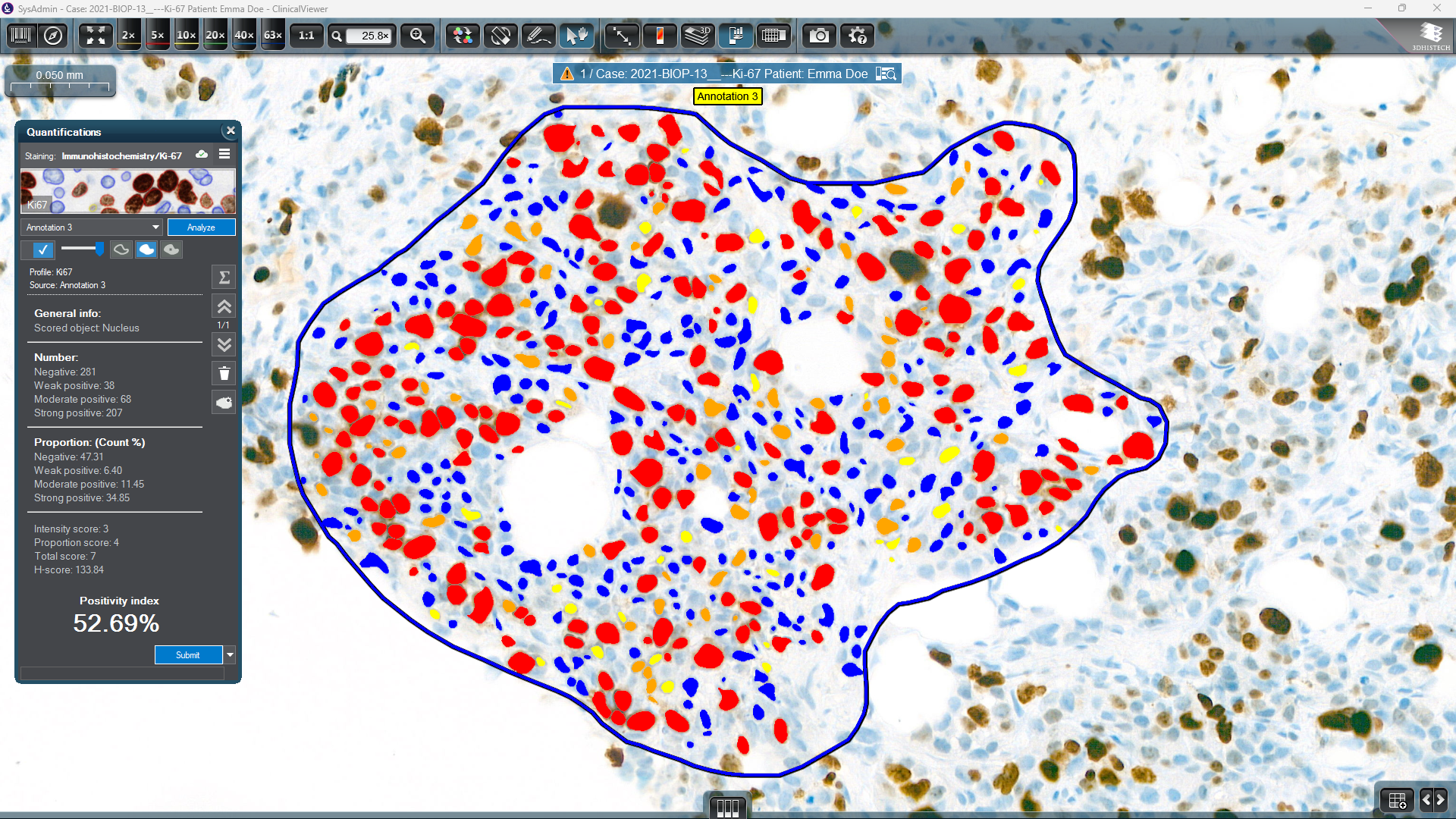3DHISTECH’s Ki-67 Quantification Module Receives IVDR Certification – Supporting Pathologists ...